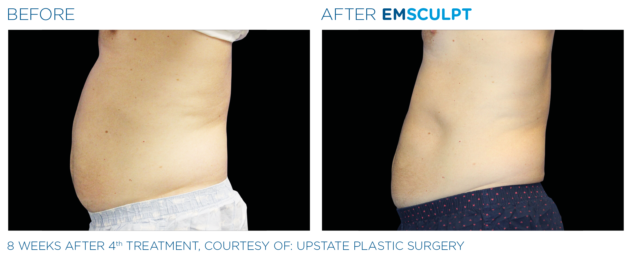 EmSculpt | Cosmetique Aesthetics Las Vegas